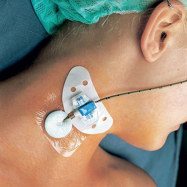 Infektionsrate bei onkologischen Patienten mit ZVK-Anlage reduzieren ...